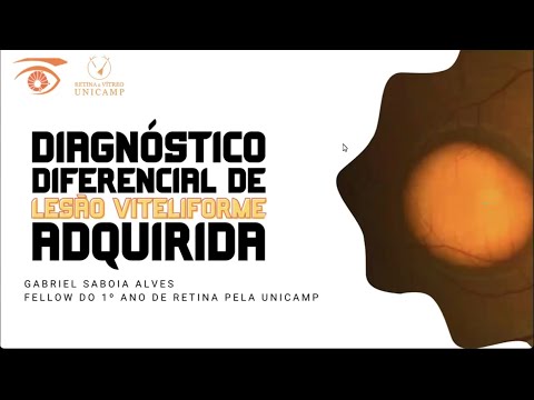Retina e Vítreo (27/06/2024) - Diagnóstico Diferencial de Lesão Viteliforme Adquirida
