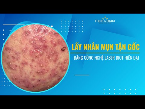 LẤY NHÂN MỤN TẬN GỐC BẰNG CÔNG NGHỆ LASER DIOT