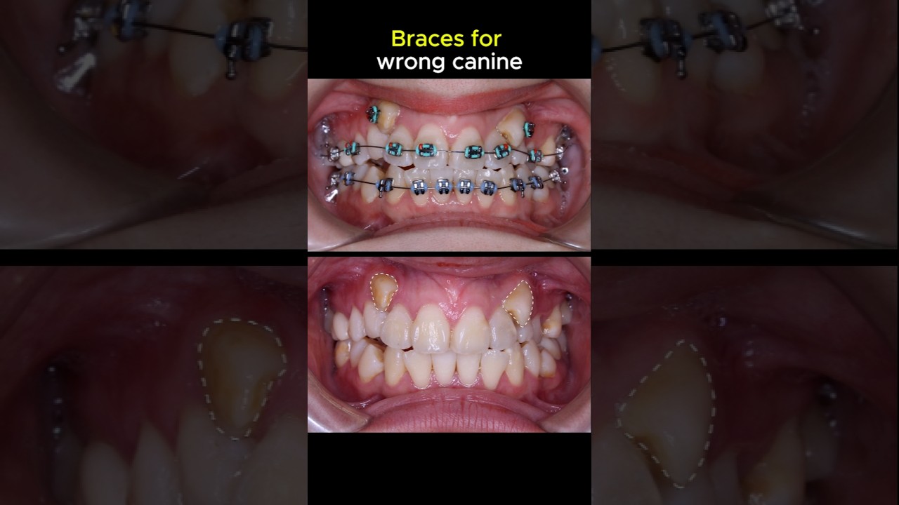 Braces progess. Fix wrong canine tooth #braces #dentist #orthodontist #teeth