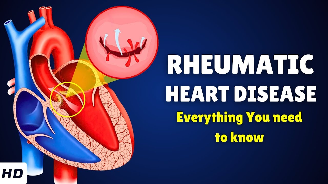 Rheumatic Heart Disease – Causes, Signs and Symptoms, Diagnosis & Treatment