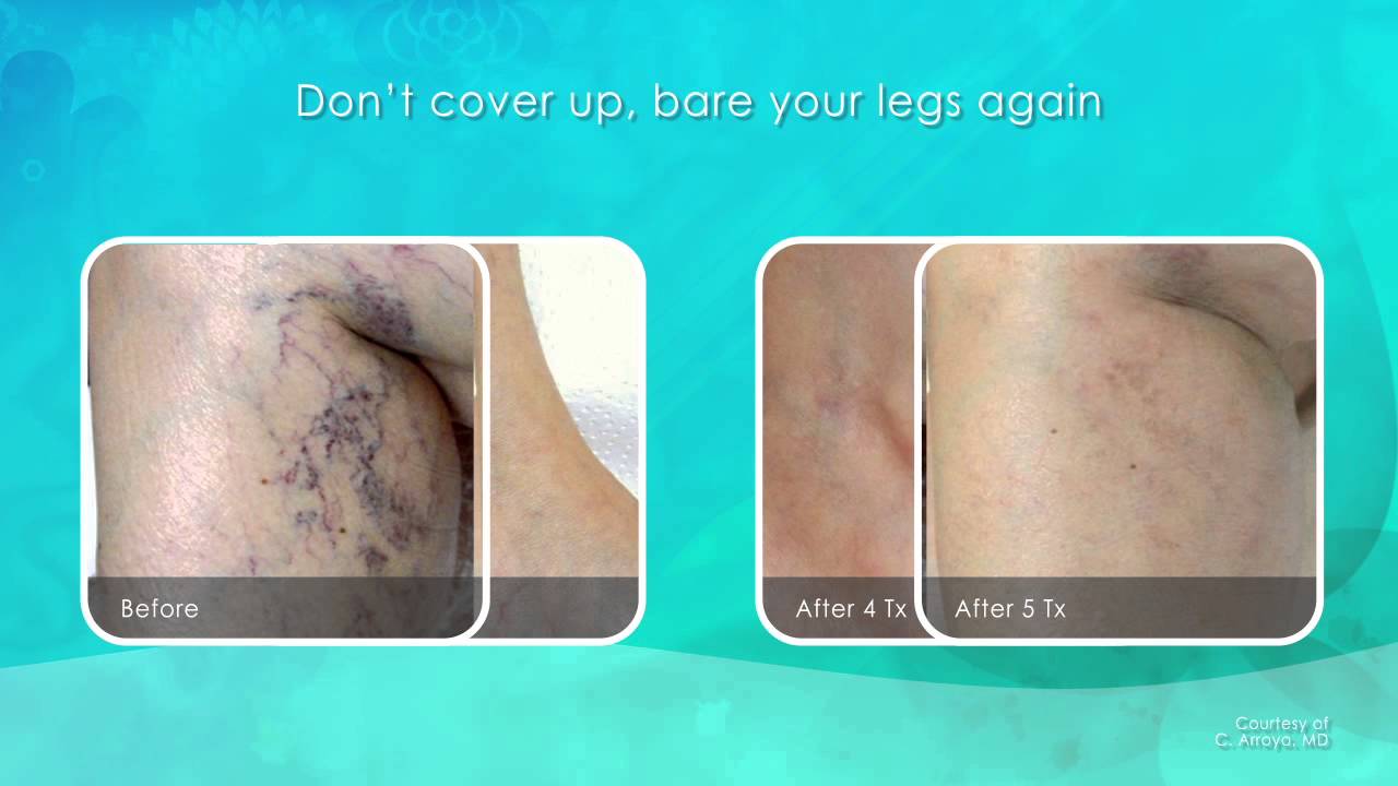 Cynergy Vein Removal
