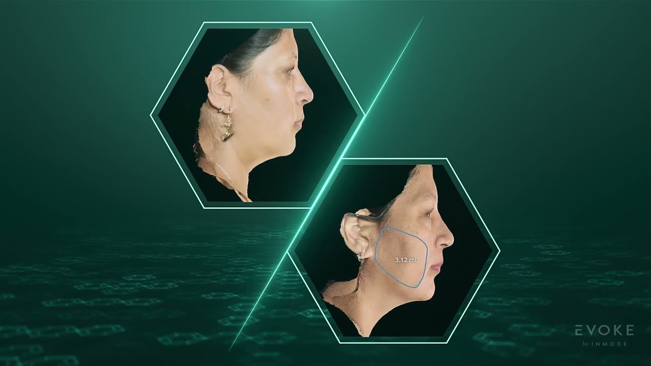 Evoke Animation Video - Vein & Cosmetic Center of Tampa Bay