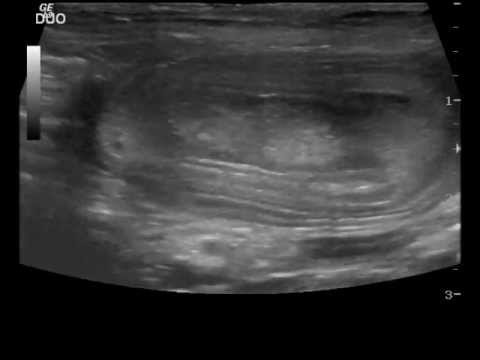 Intussusception
