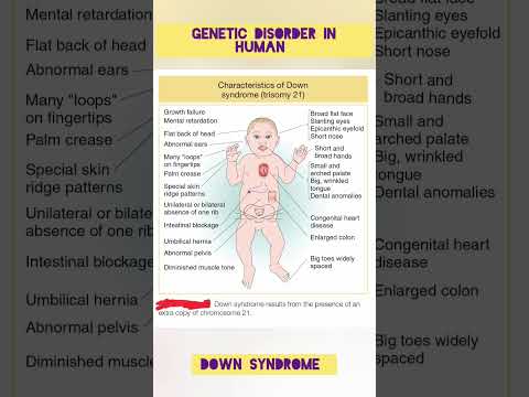 Down Syndrome | Trisomy 21 | Genetic Disorder in Human