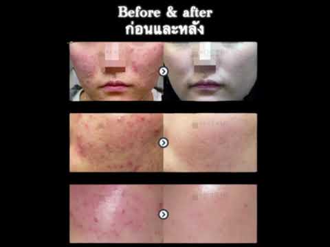 Quick acne treatment