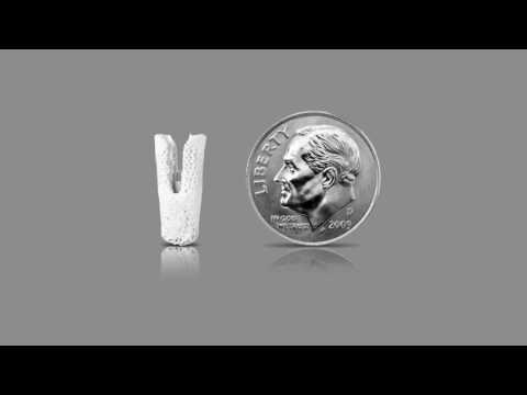 Minimally invasive treatment for mitral valve regurgitation | Ohio State Medical Center