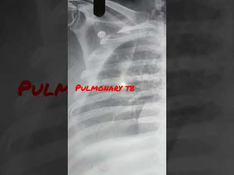 left upper lobe cavitatory infiltrate