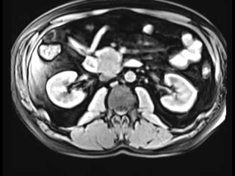 Duodenal GIST
