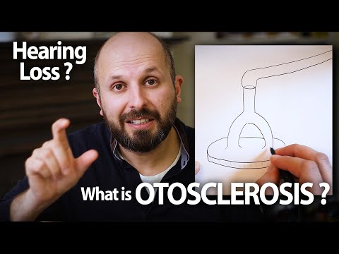 How to fix hearing loss if you have Otosclerosis (stapedectomy)