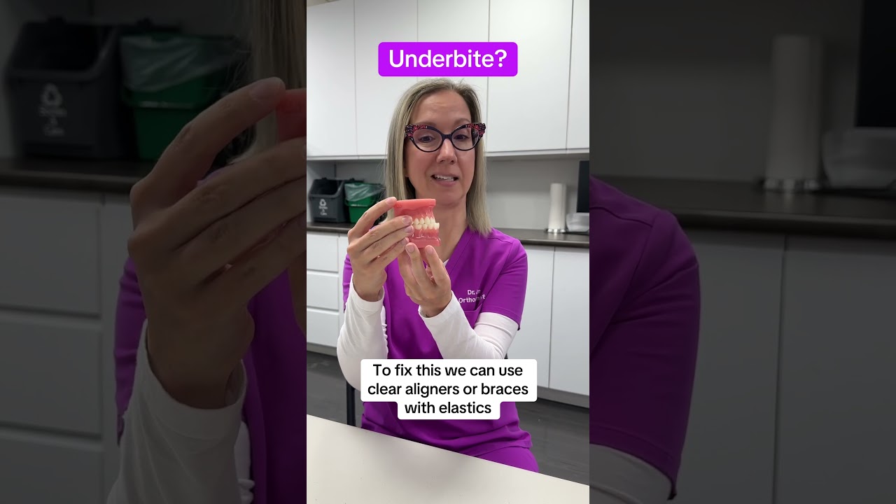 Underbite Correction: What You Need to Know