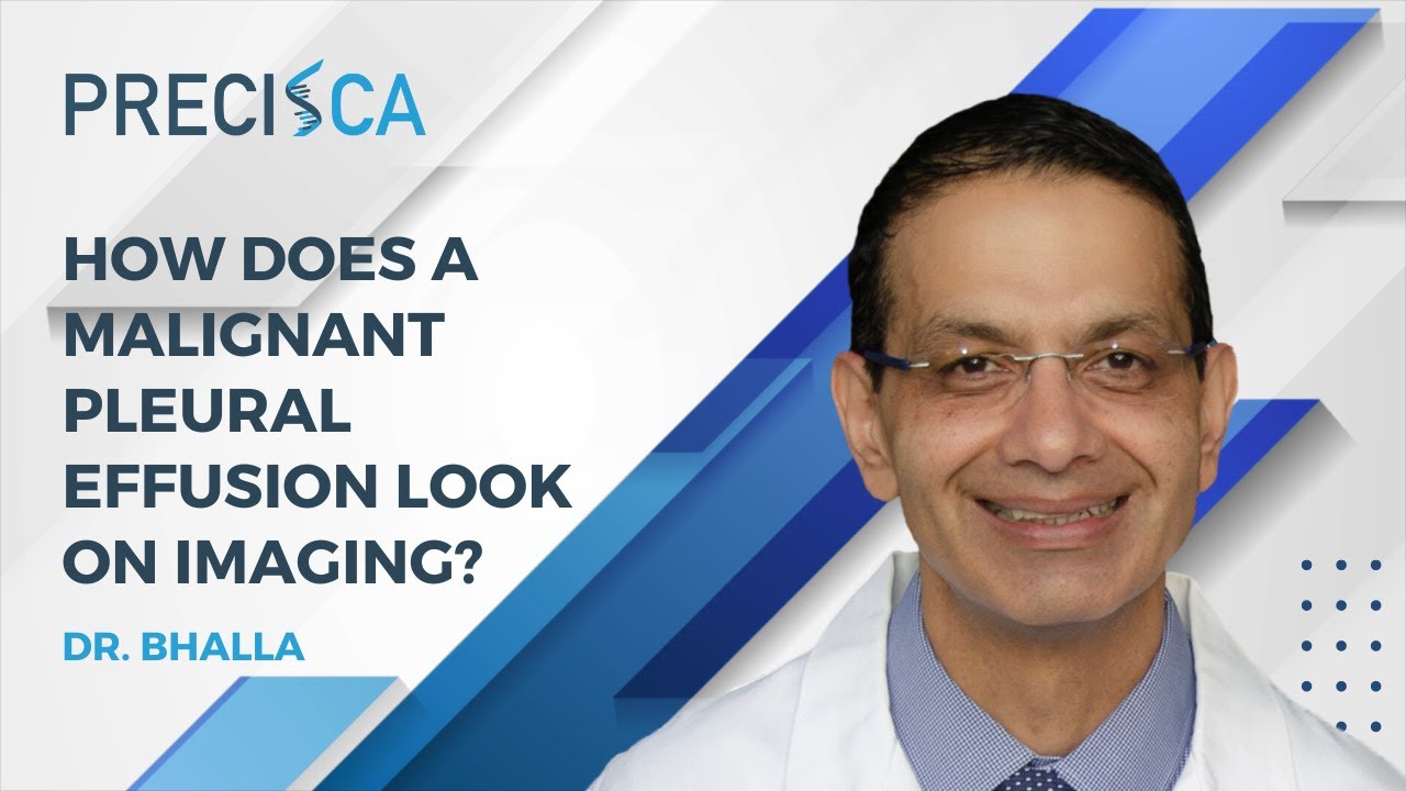 How does a malignant pleural effusion look on imaging?