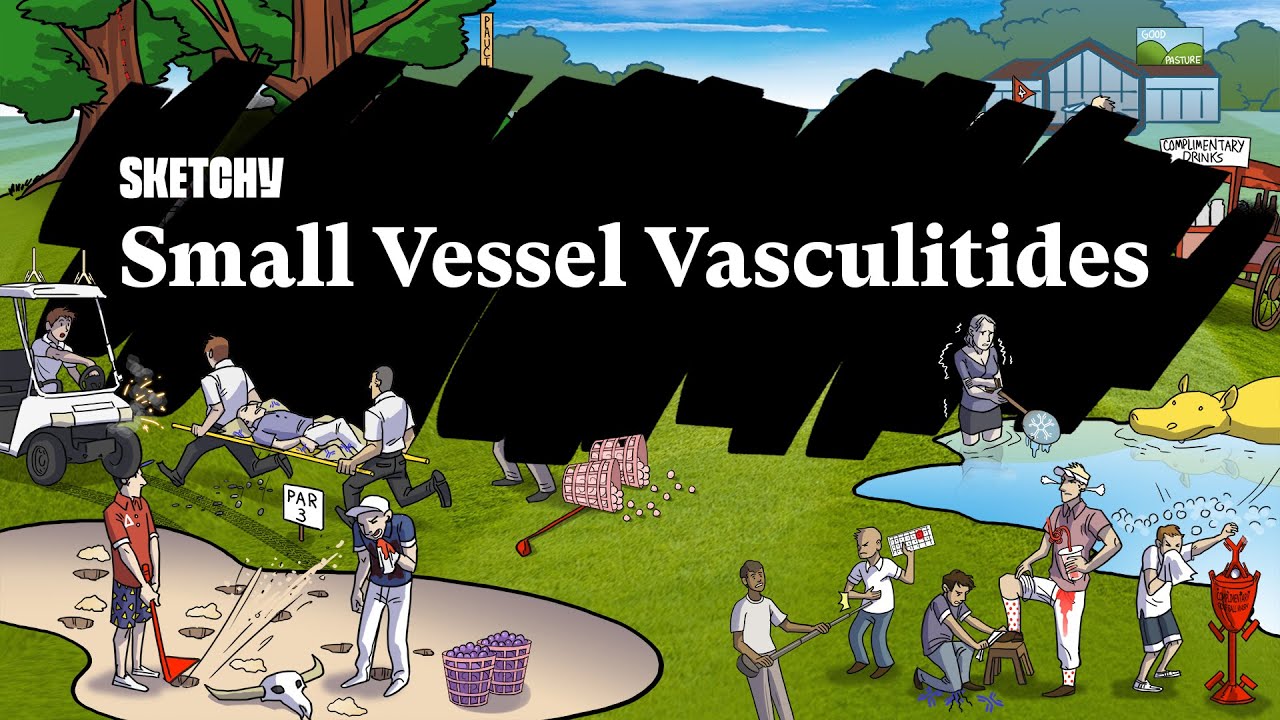 Small Vessel Vasculitides (Part 1) | Pathophysiology | Sketchy Medical | USMLE Step 1