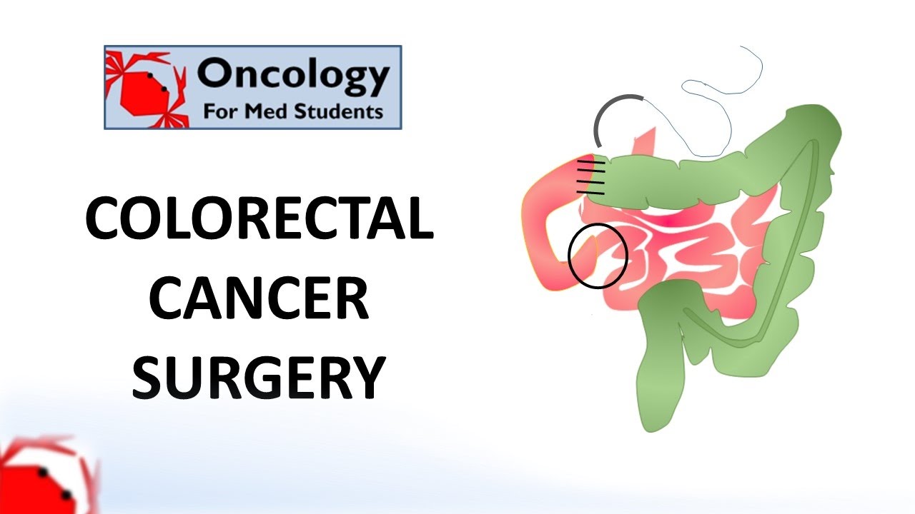 Understanding Colorectal Cancer Surgery: Principles and Types | Galaxy.ai