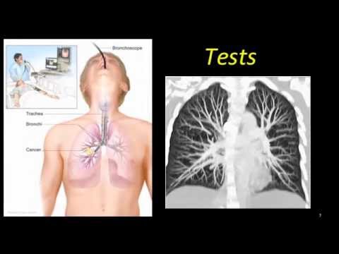 Idiopathic Pulmonary Fibrosis