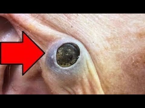 The Largest Dilated Pore of All Time - Pimple  Popper wow blackheads