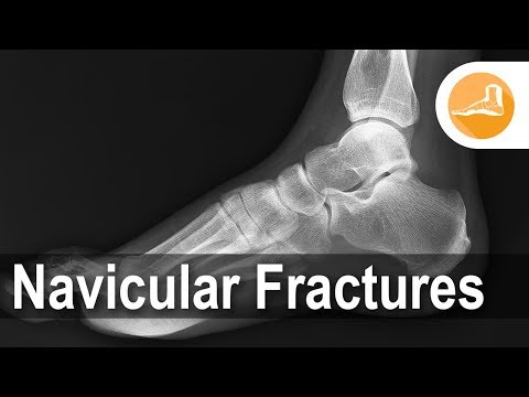 Navicular Fractures with Dr. Erik Nilssen