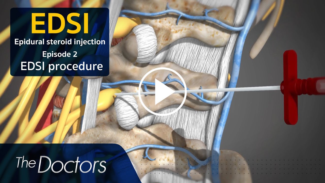 The Doctors Epidural Steroid Injection (EDSI) procedure