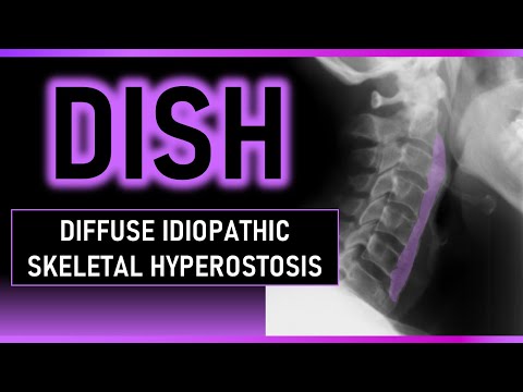Diffuse Idiopathic Skeletal Hyperostosis #dish #radiology #bones