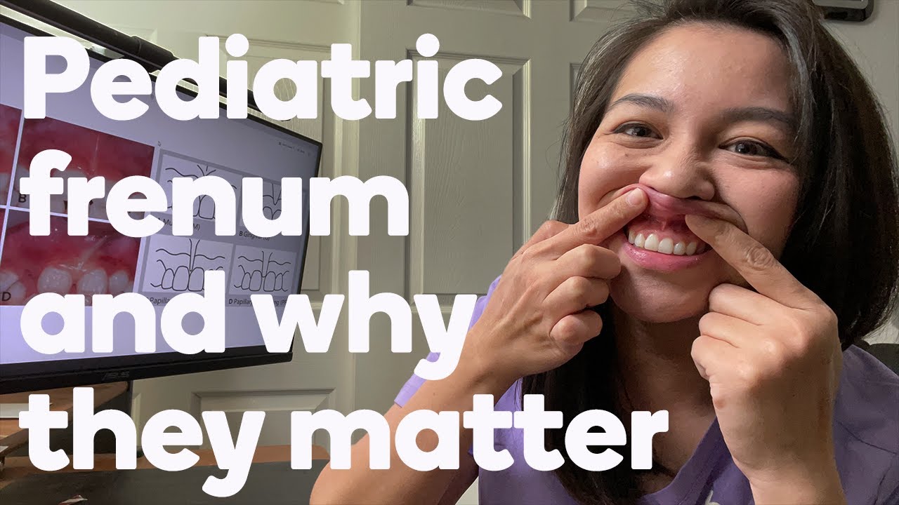 Pediatric frenums and why you should be looking at them