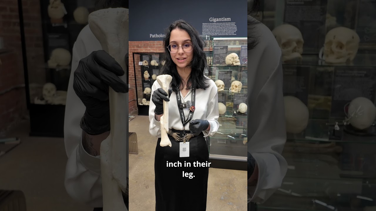 Exploring a oblique￼ tibia fracture