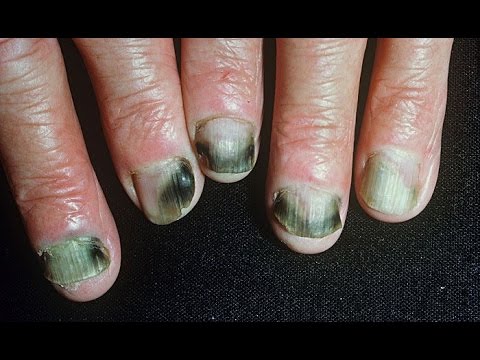 Trimming fungal fingernails and calluses – Site Title