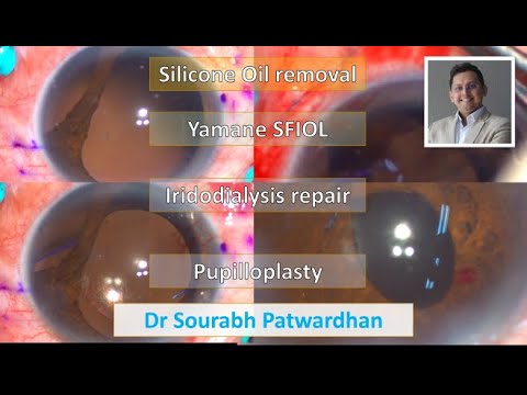 Phaco Training: Dr. Sourabh Patwardhan discusses Yamane Technique of SF ...