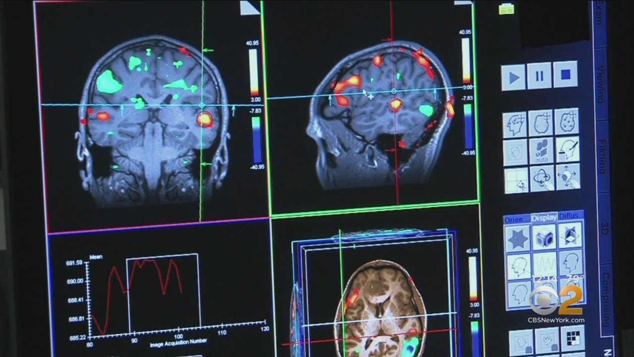 Study: High Blood Pressure Linked To Dementia