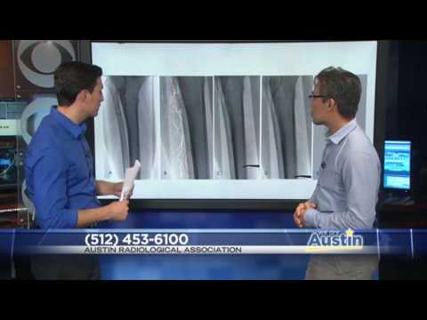 ARA's Dr Nguyen Discusses Peripheral Arterial Disease