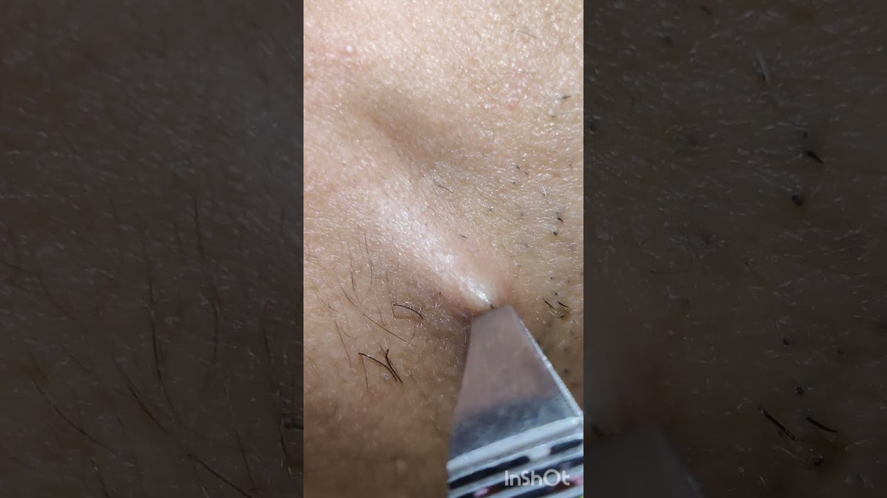 Satisfying video Remove unwantd facial hair with twezer/ASMR #ingrown #hairremoval #asmr #satisfying