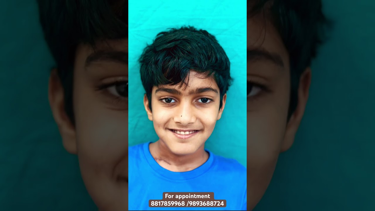 Tilted neck ( Torticolis) #torticollis #drsunilrathore