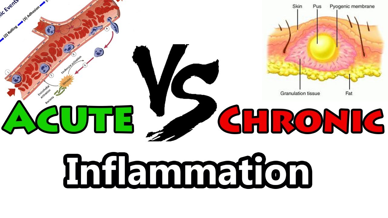 Acute Inflammation vs Chronic Inflammation ( Clear Comparison  )