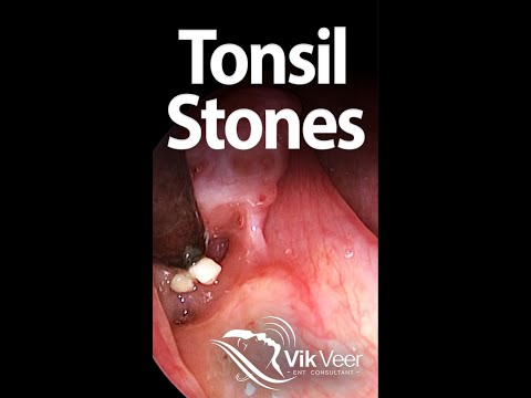 Tonsil stones forming in a large tonsil fissure.