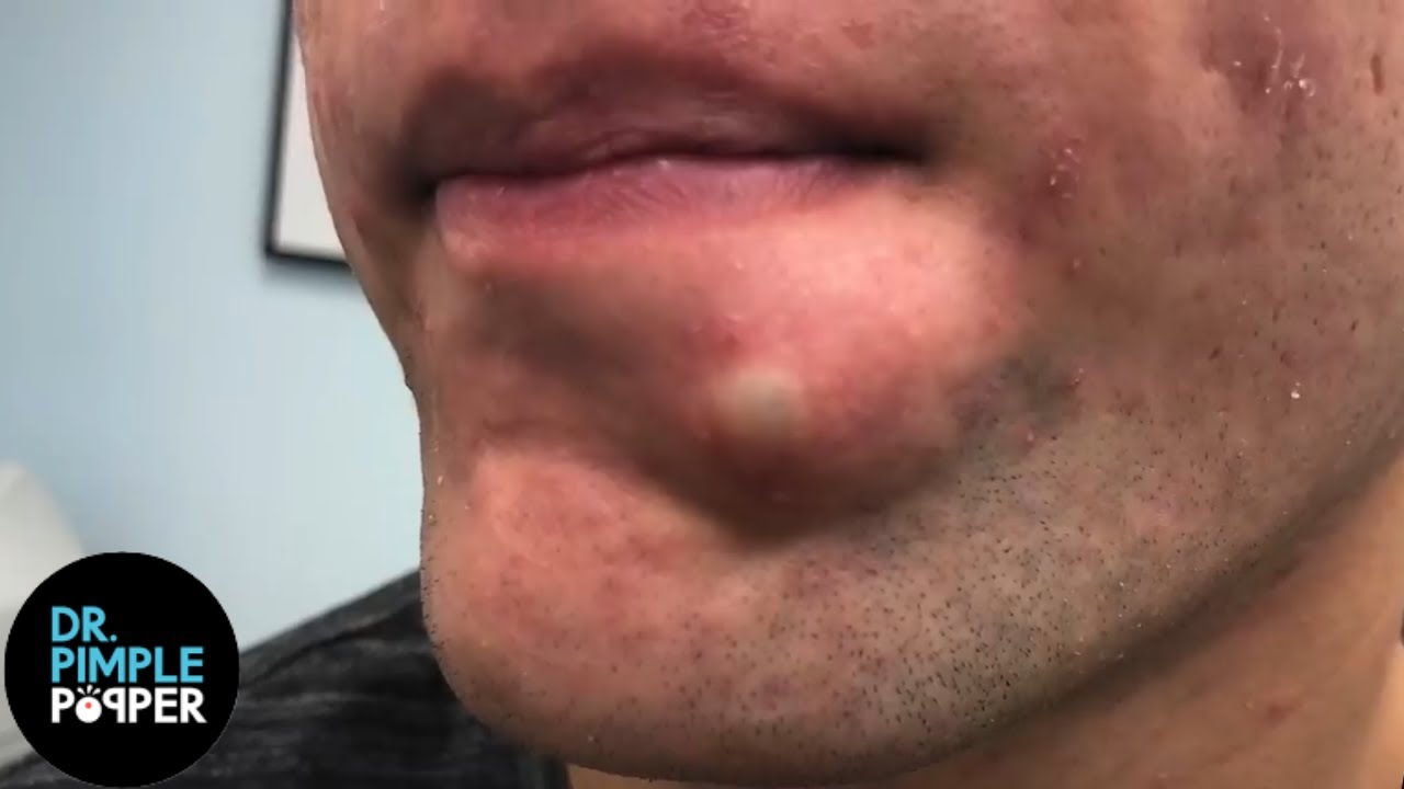 SATISFYING Dr Lee Pops Inflamed Cyst On Chin Dr Pimple Popper Reacts SATISFYING Dr Lee Pops Inflamed Cyst On Chin Dr Pimple Popper Reacts