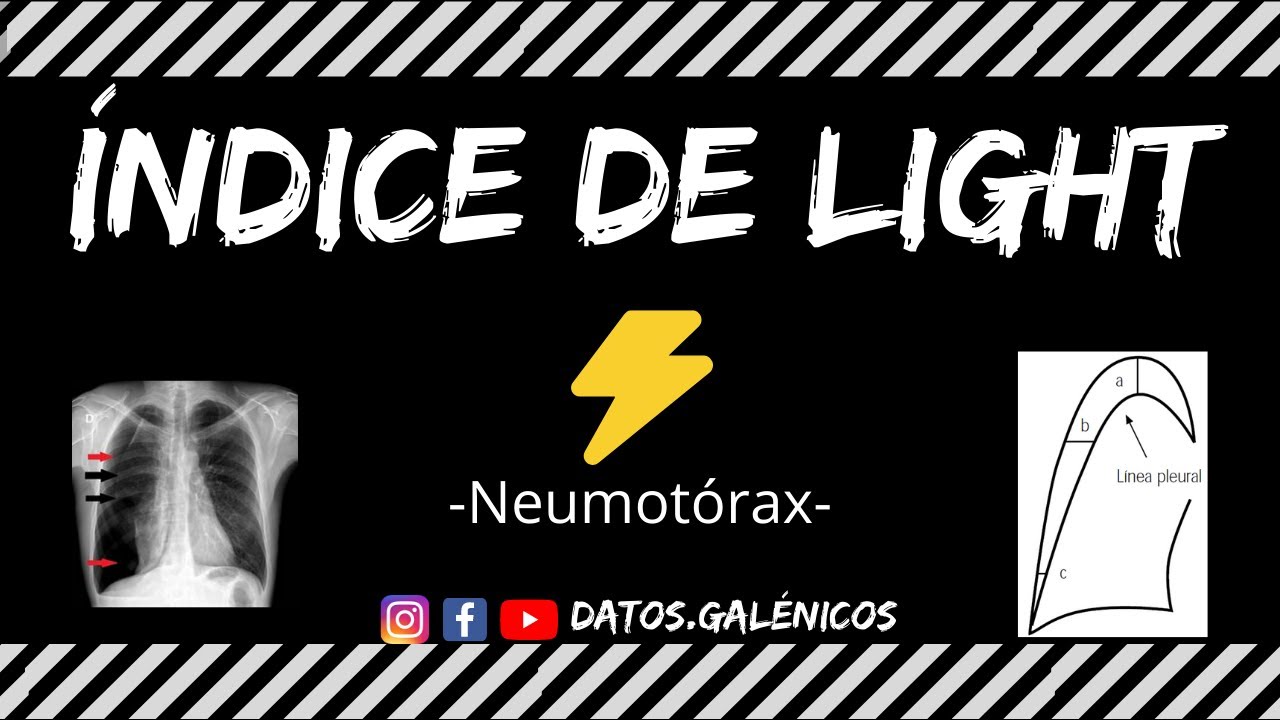 índice de Light -  Método para calcular el tamaño de un neumotórax en %