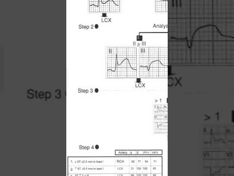RV MI & RCA occlusion on ECG.