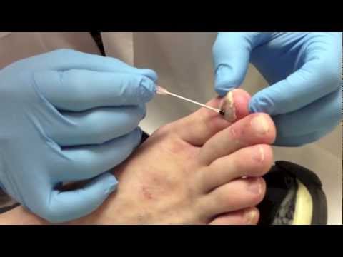 Nail Trephination – Combat Medicine 101