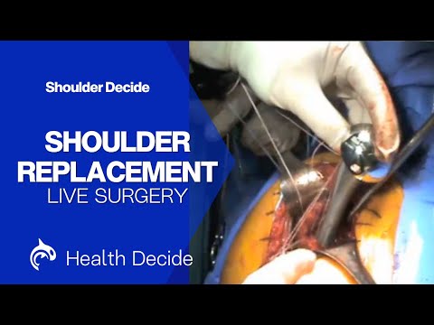 Shoulder Replacement Surgery (Shoulder Arthroplasty) - Live Surgery