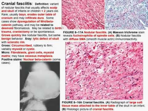 BST-Soft tissue pathology101-Fibrous & fibrohistiocytic lesions.mov