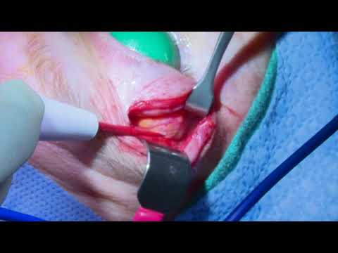 Spheno-orbital meningioma resection via eyelid crease approach