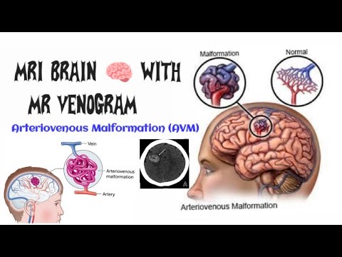 Arteriovenous Malformation | AVM | MRI BRAIN 🧠WITH MR VENOGRAM