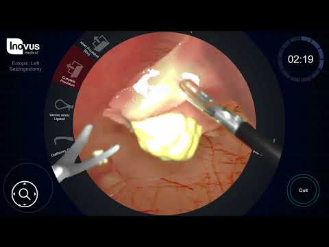 Salpingectomy