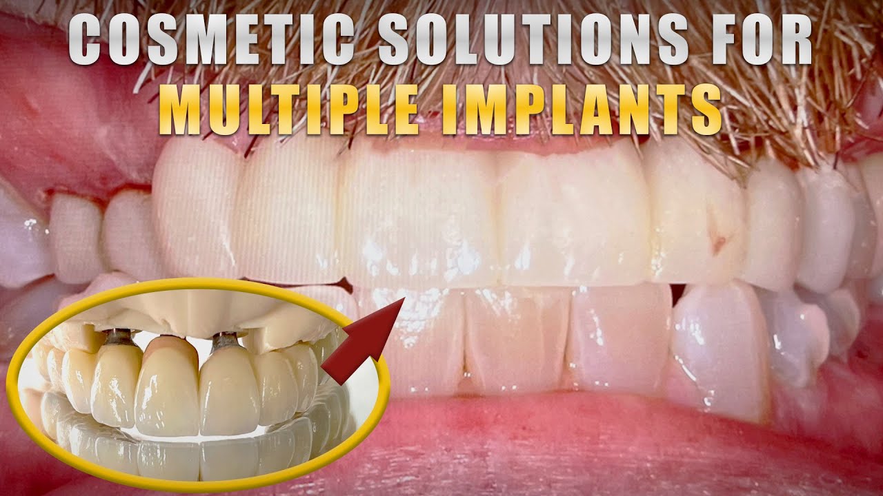 Cosmetic Solutions for Multiple Implants