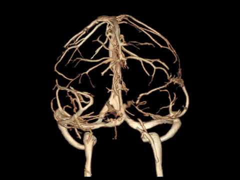 CT brain venogram