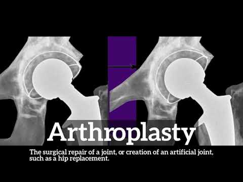 How Does Arthroplasty Look? | What is Arthroplasty? | How to Say Arthroplasty in English?