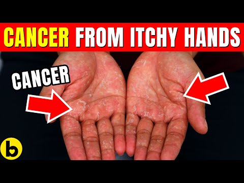 Womanâs âItchy Handsâ Turned Out To Be Sign Of Rare Terminal Cancer
