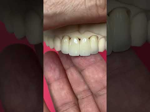Anterior Pontic Bridge @EnvisiontecMain #envisiontec