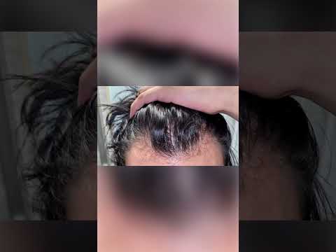 Finasteride results! #finasteride #hairlosstreatment #hair #hairlosscure #hairloss