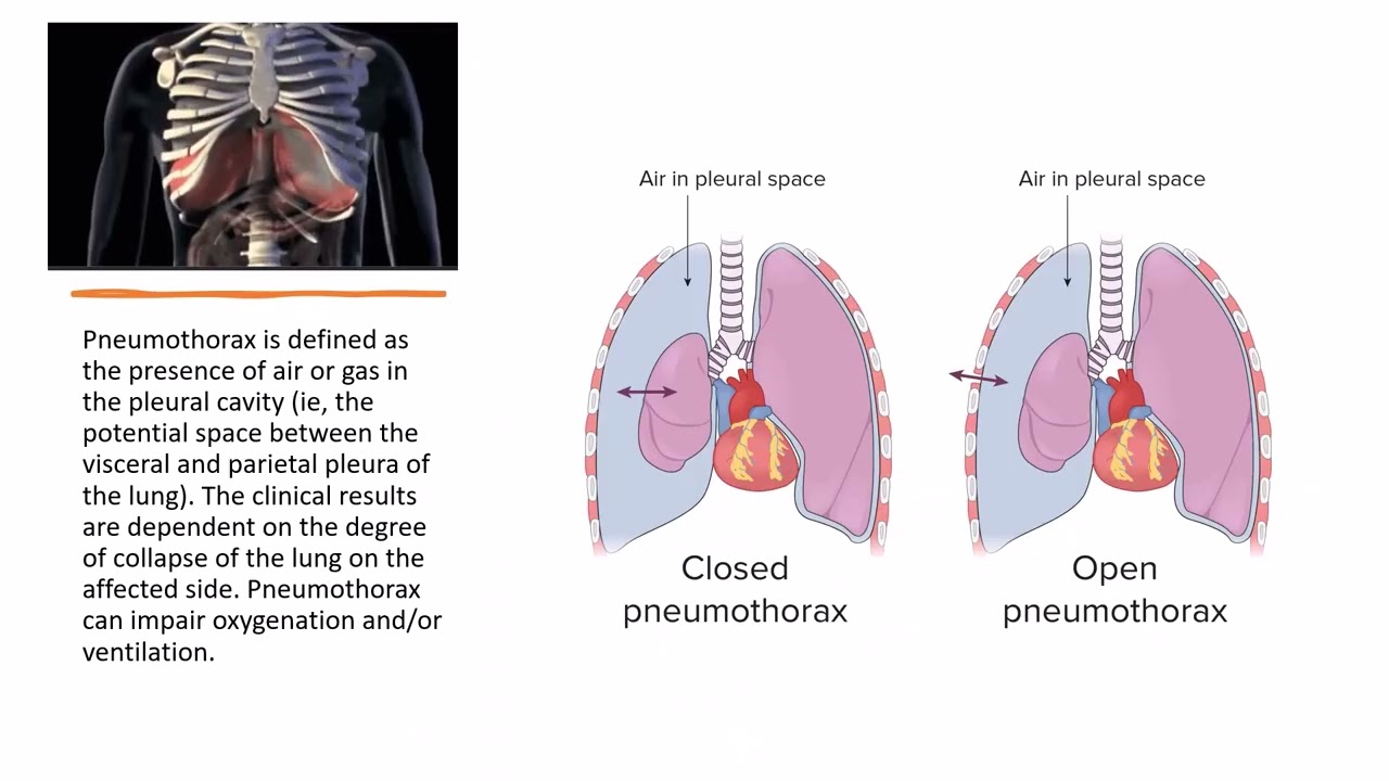 Take in a deep breath - Pneumothorax and Hemopneumothorax