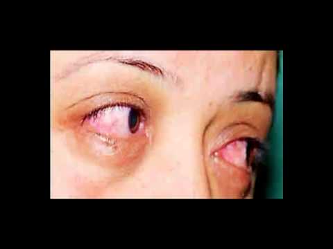 Do You Suffer From Allergic Shiners?