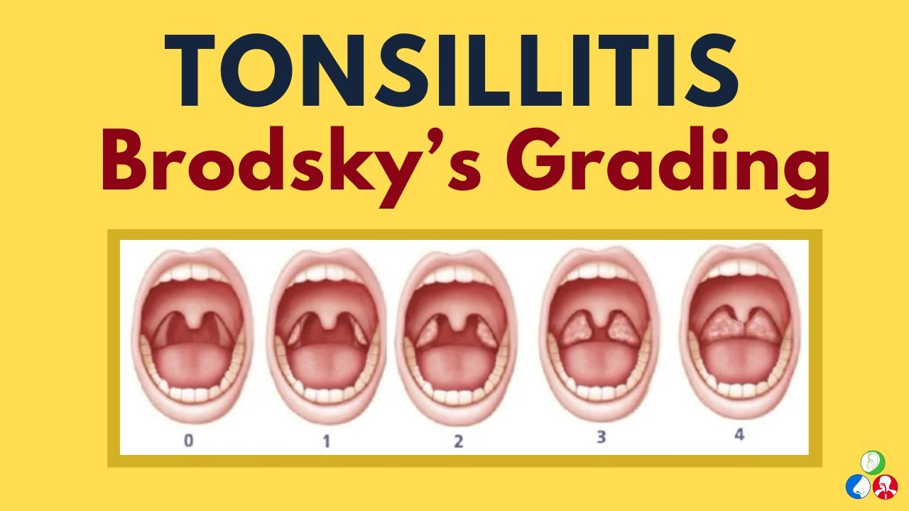 Tonsillitis Grading - Brodsky | Grades of tonsillar enlargement | ENT Viva Voce